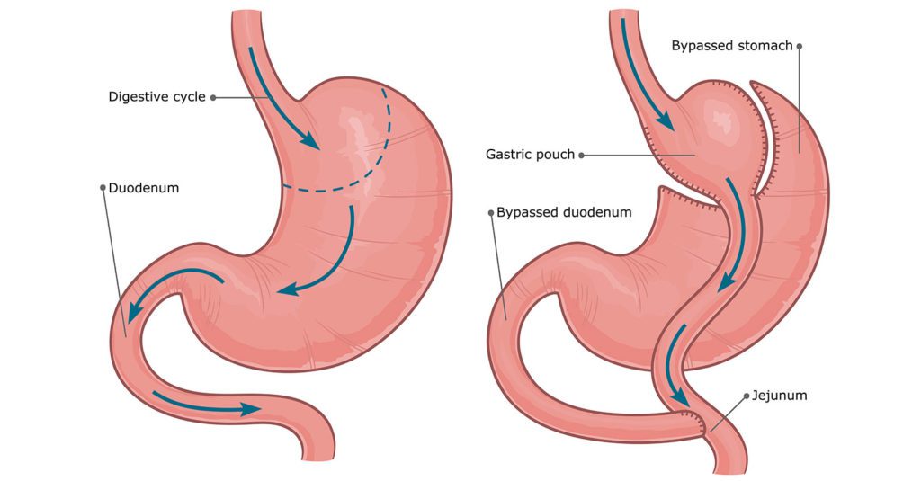 Gastric Bypass Surgery Starlet ClinicStarlet Clinic Gastric Bypass Surgery Starlet ClinicStarlet Clinic
